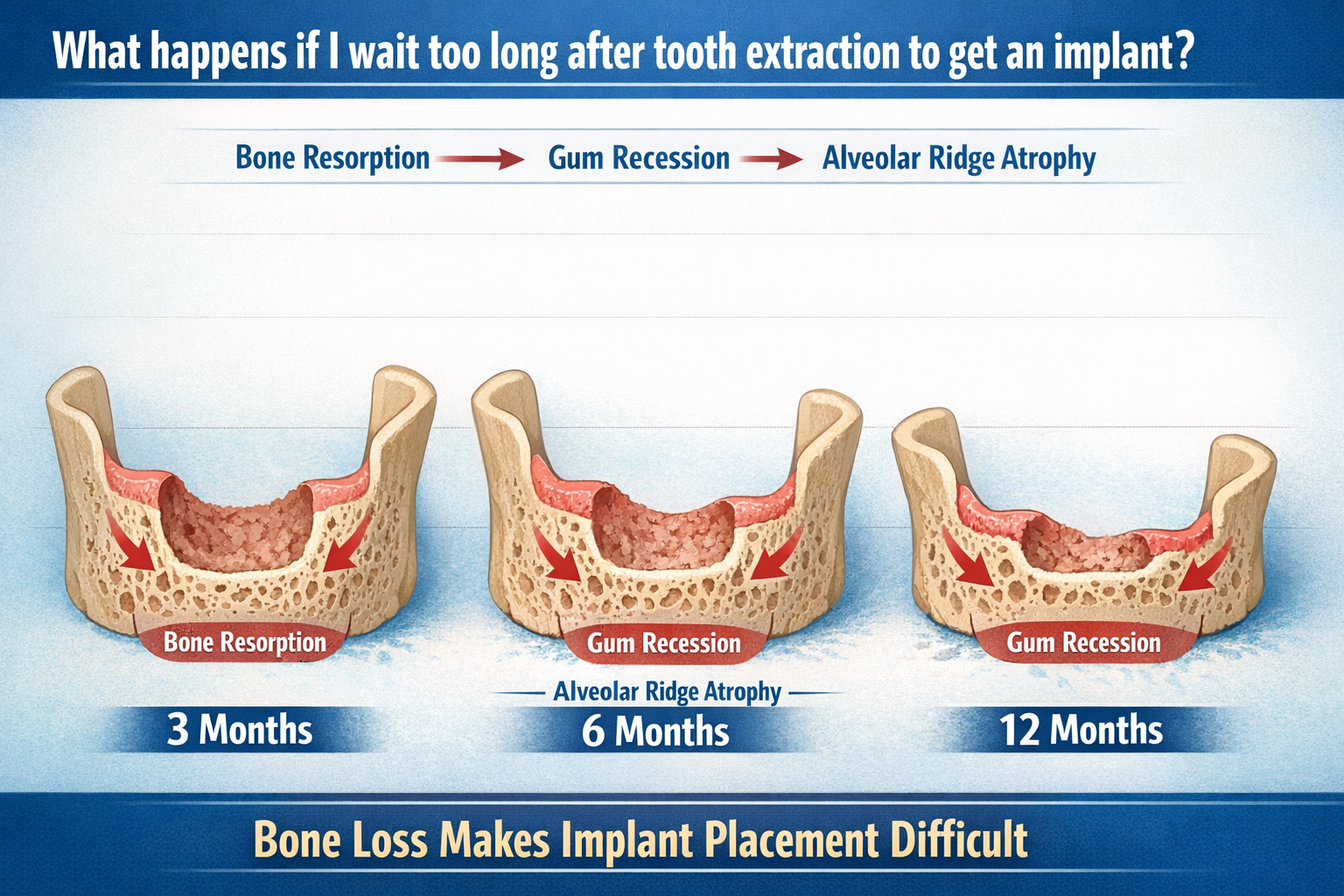What Happens If You Wait Too Long for Dental Implants?